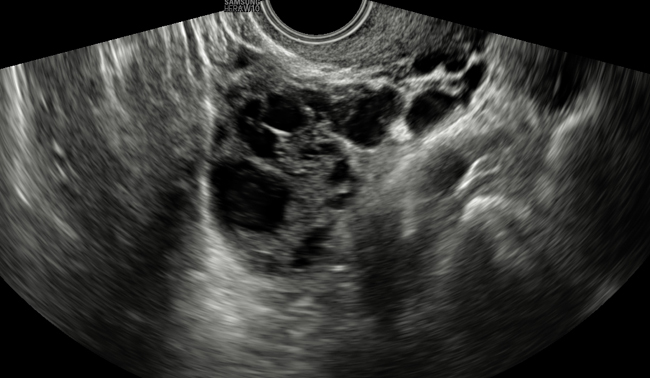 Gynaecologic ultrasound scans - PROFEMA