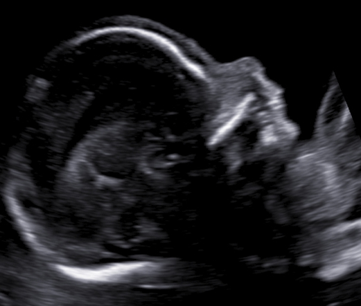 Down Syndrome Ultrasound Markers