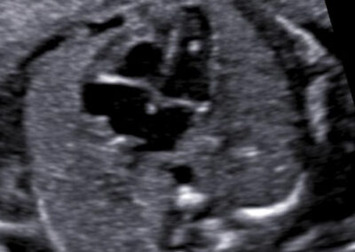 Genetic ultrasound - PROFEMA